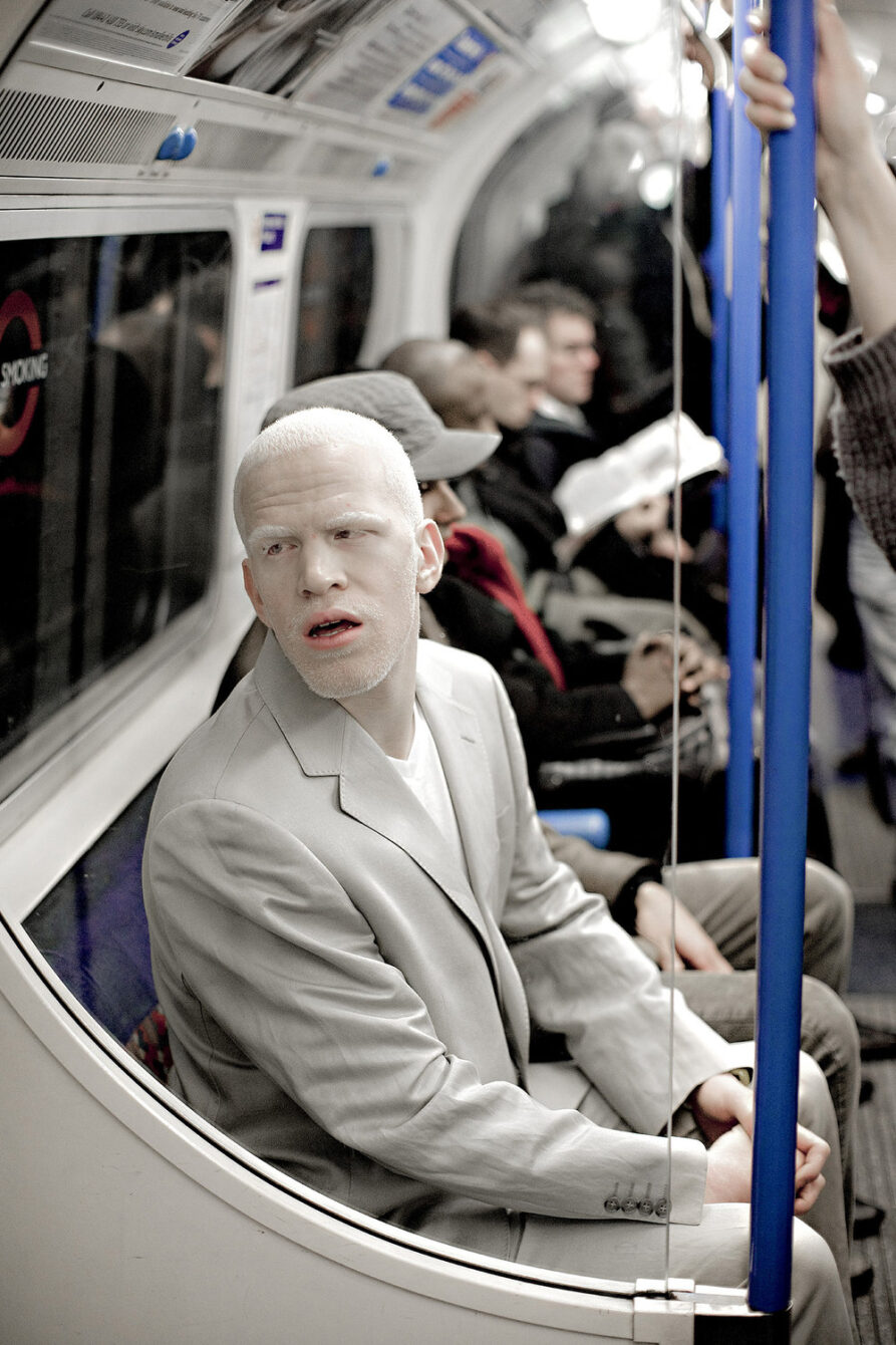 Living With Albinism - Photography Chronicle