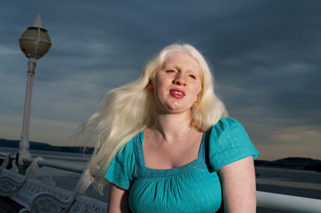 Living With Albinism - Photography Chronicle