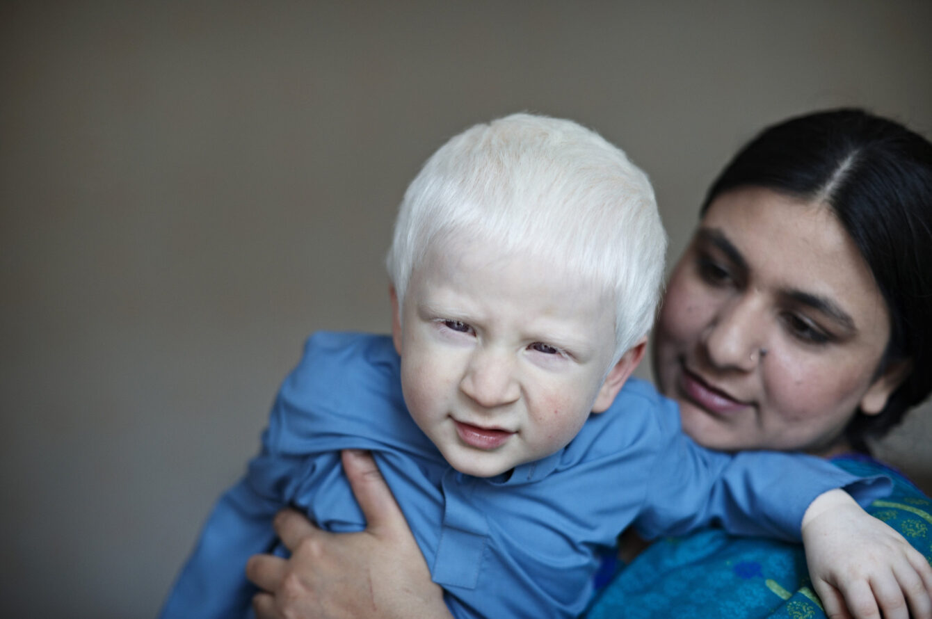 Living With Albinism - Photography Chronicle
